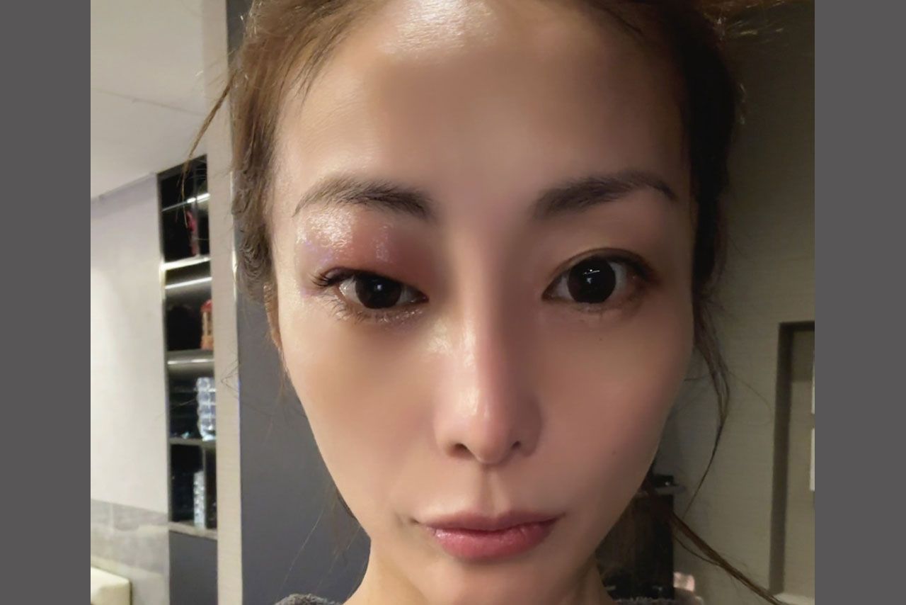 熊切あさ美、『クインケ浮腫』で腫れが引かず「人前に出られない顔に」SNSでも公開を躊躇したその症状 | 週刊女性PRIME